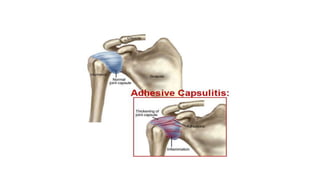 Adhesive capsulitis | PPTX