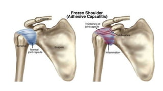 ADHESIVE CAPSULITIS-456654556643589.pptx