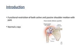 ADHESIVE CAPSULITIS (FROZEN SHOULDER).PPT