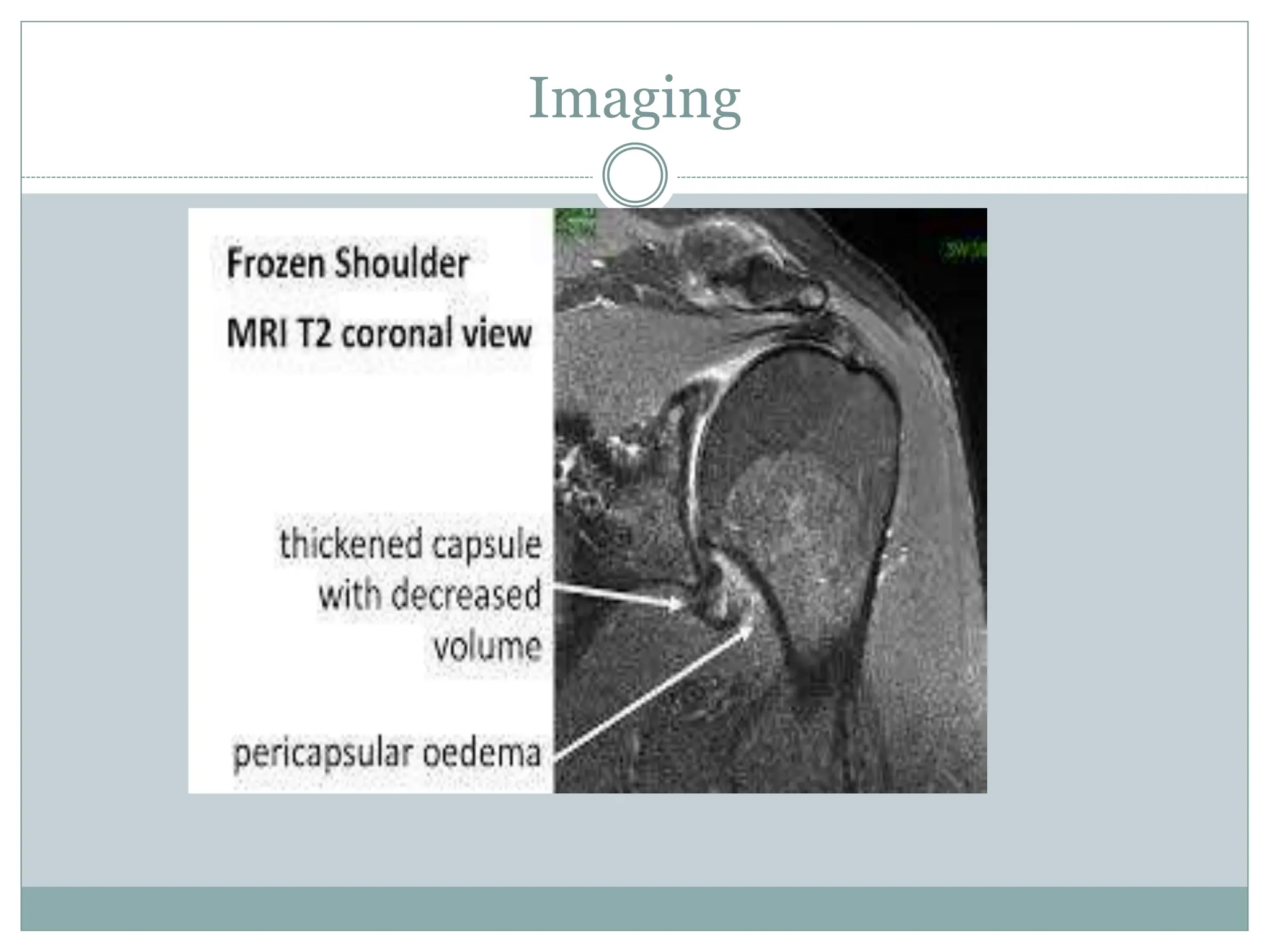 ADHESIVE CAPSULITIS /frozen shoulderppt.pptx