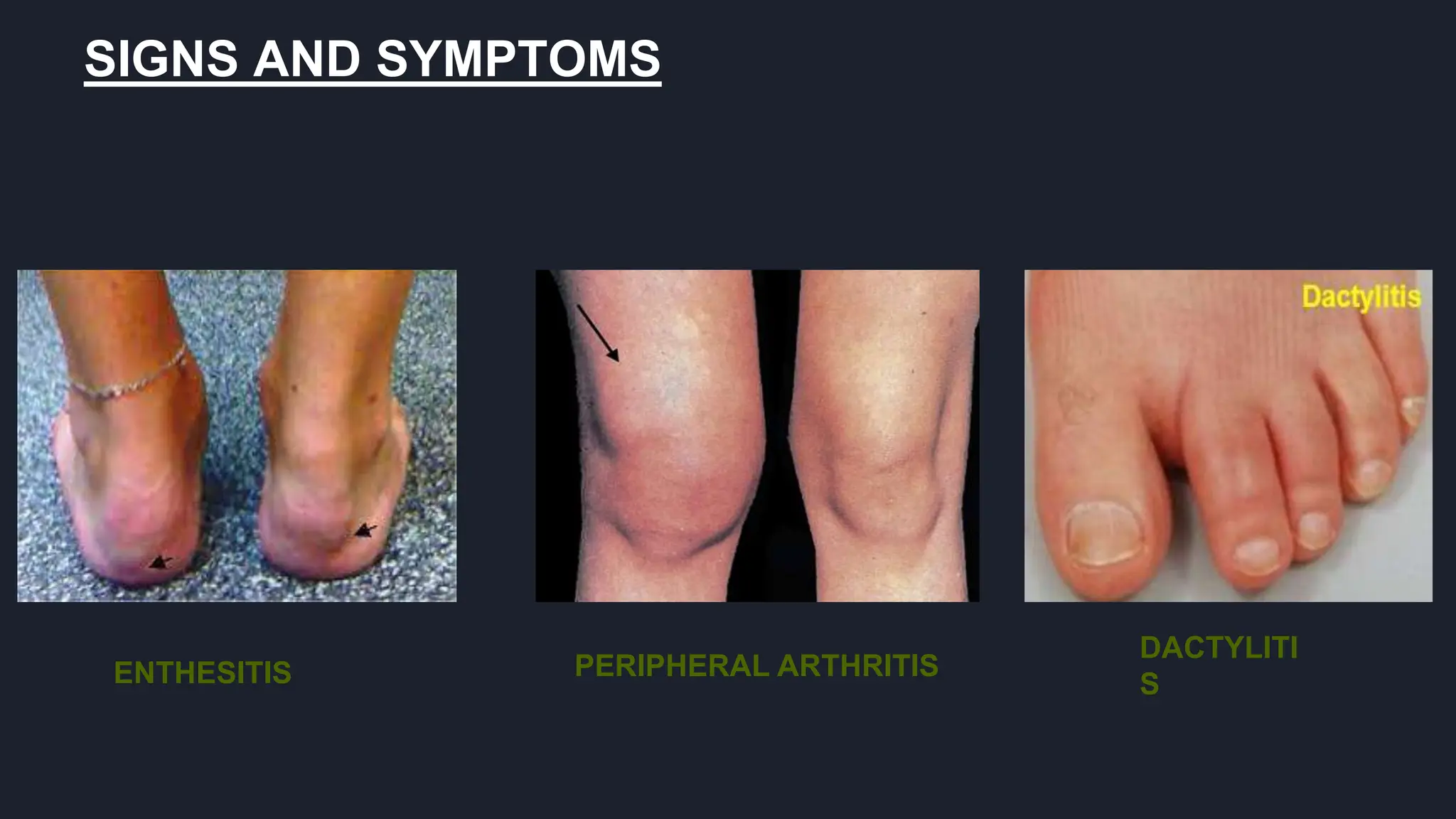 ANKYLOSING SPONDYLITIShhhhhhhhhhhhh.pptx