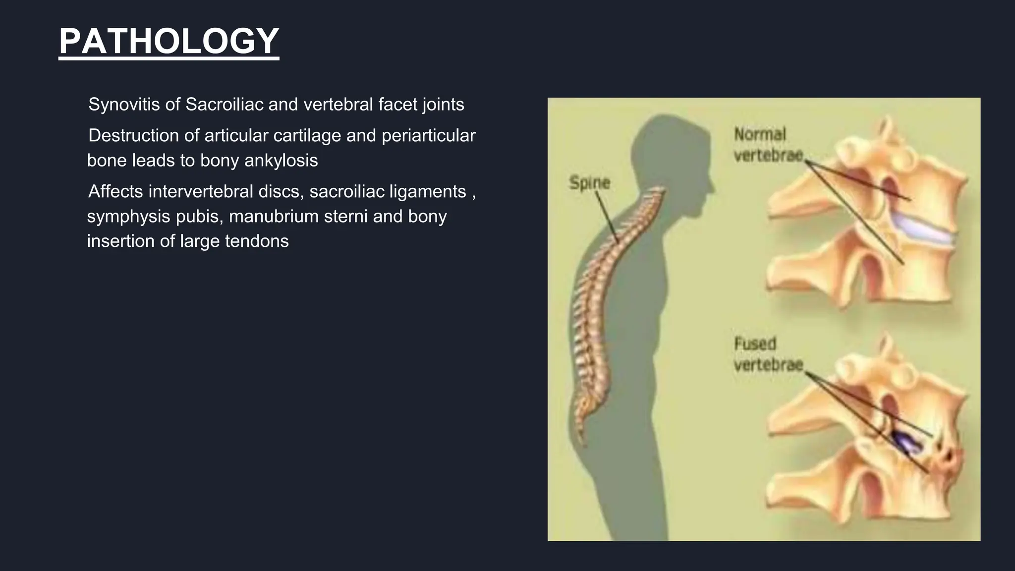 ANKYLOSING SPONDYLITIShhhhhhhhhhhhh.pptx