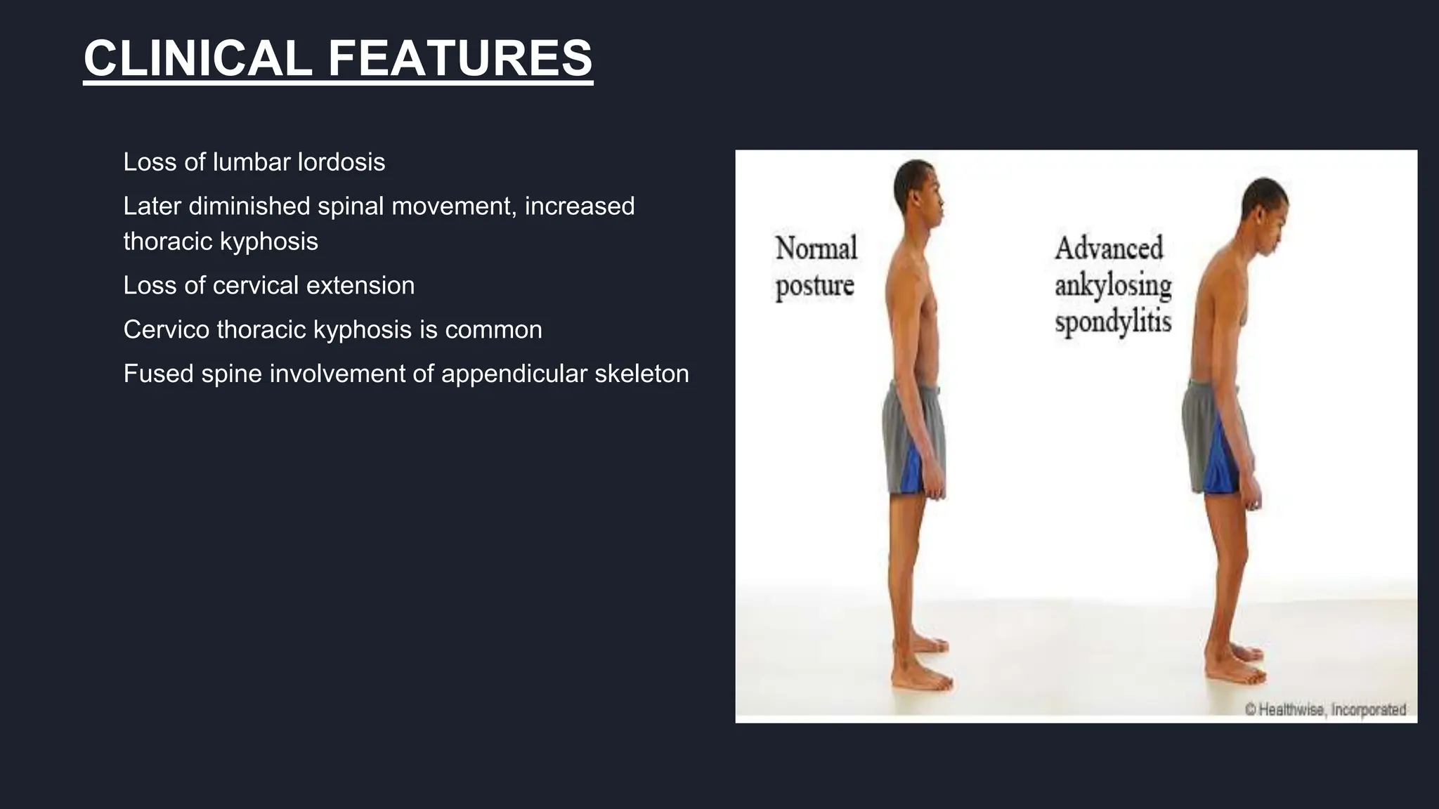 ANKYLOSING SPONDYLITIShhhhhhhhhhhhh.pptx