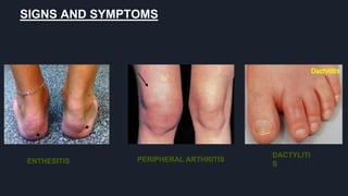 ANKYLOSING SPONDYLITIShhhhhhhhhhhhh.pptx