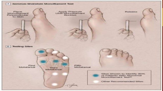 A diabetic patient with wound on foot