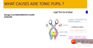 Adie Tonic Pupil 06 Nov 2022.pdf