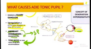 Adie Tonic Pupil 06 Nov 2022.pdf