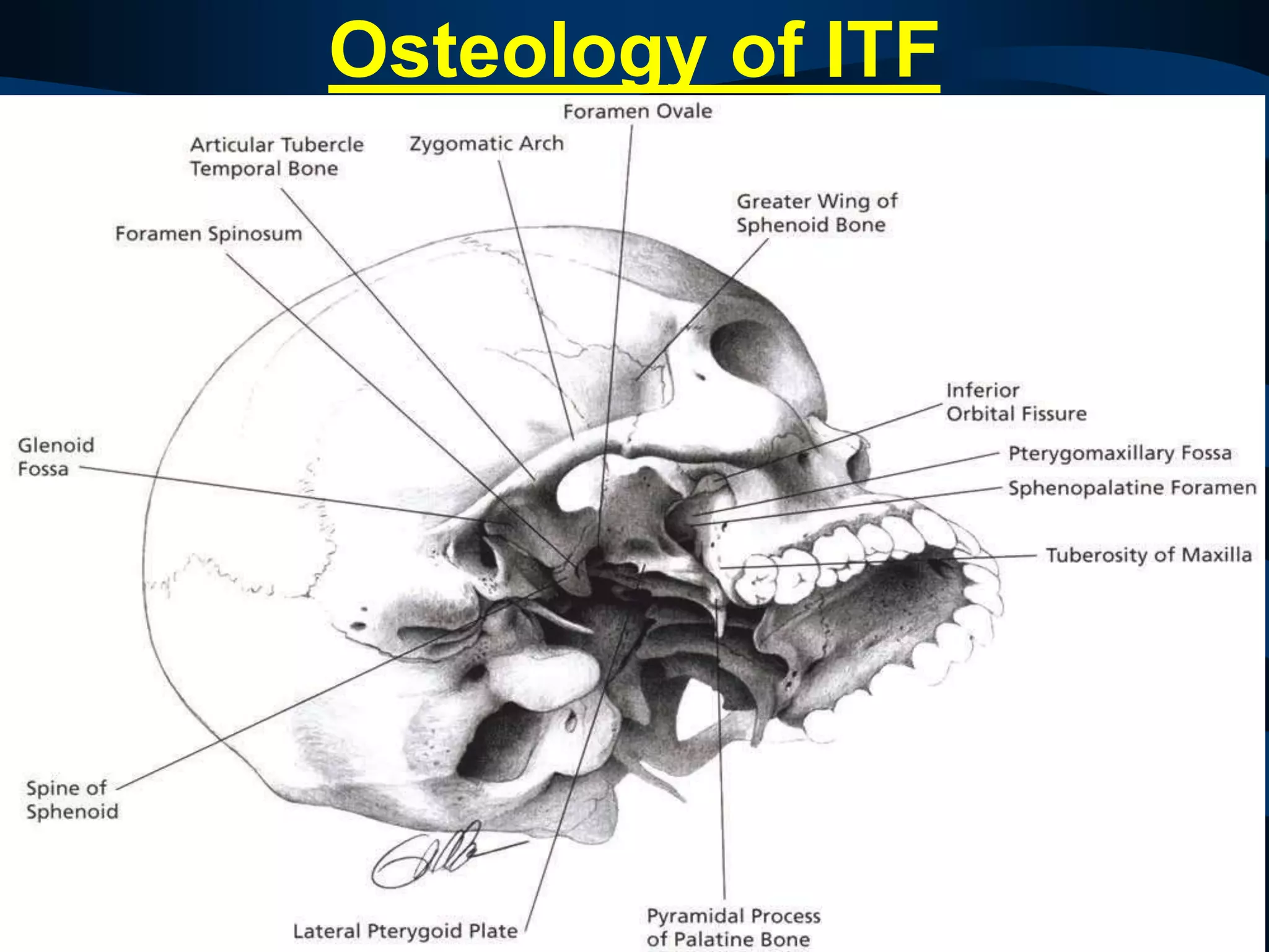 Surgical anatomy of Infratemporal fossa. by Dr. Aditya Tiwari | PPTX