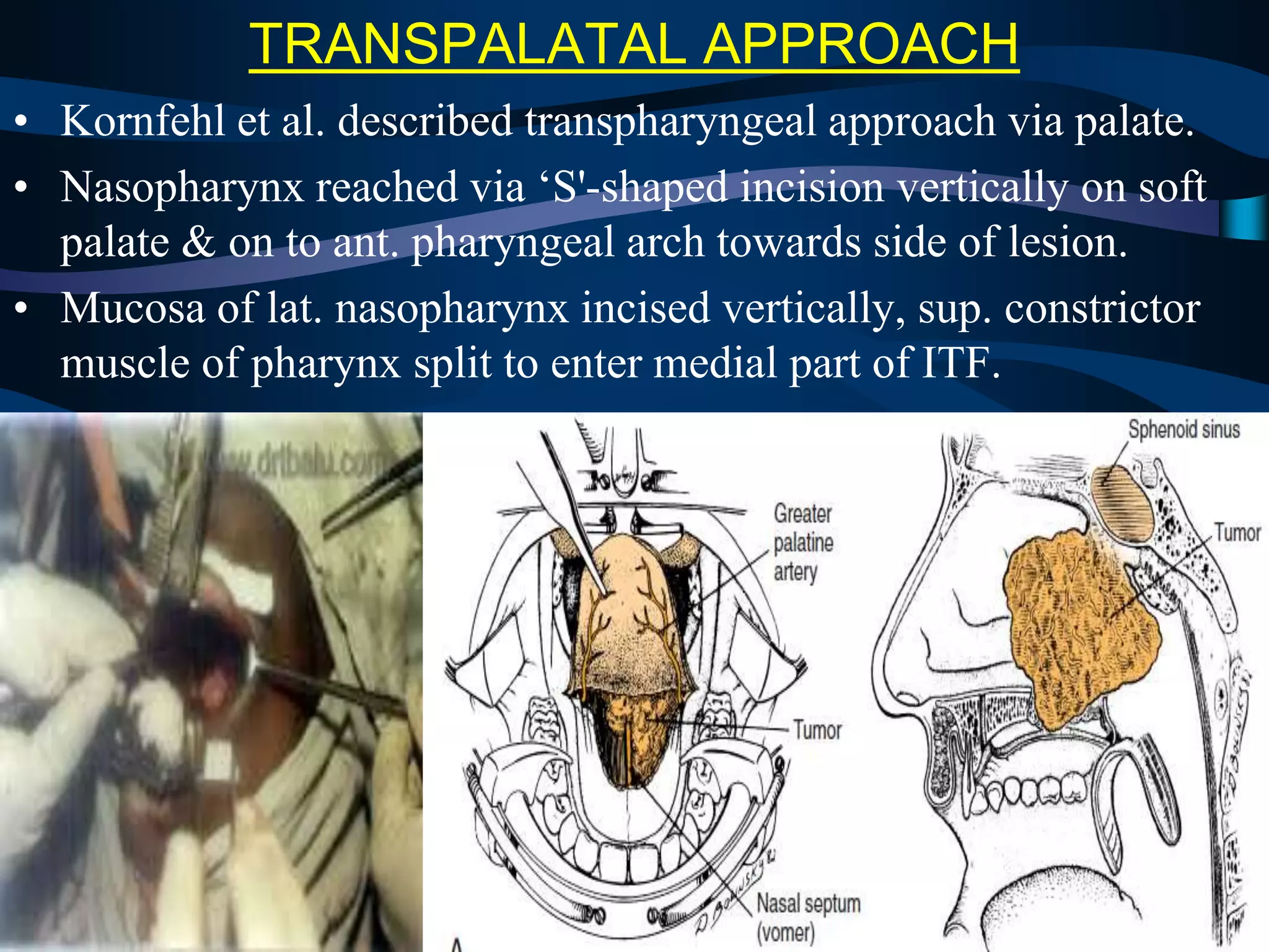 Surgical anatomy of Infratemporal fossa. by Dr. Aditya Tiwari | PPTX