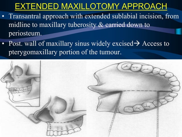 Surgical anatomy of Infratemporal fossa. by Dr. Aditya Tiwari | PPTX