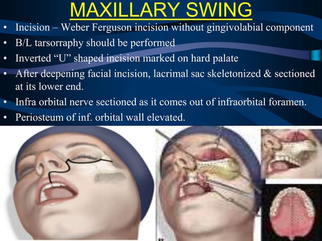 Surgical anatomy of Infratemporal fossa. by Dr. Aditya Tiwari | PPTX