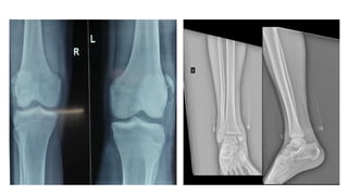 Radiological findings diaphragmatic injury | PPTX