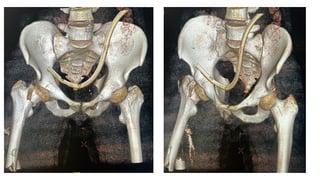 Radiological findings diaphragmatic injury | PPTX