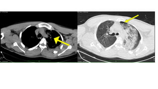 Radiological findings diaphragmatic injury | PPTX