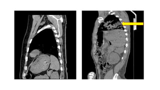 Radiological findings diaphragmatic injury | PPTX