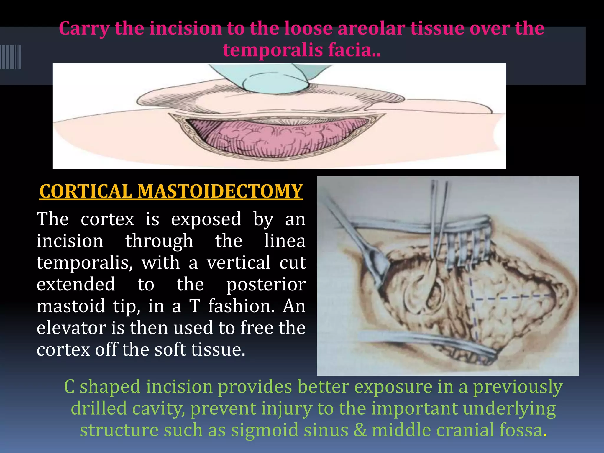 Canal wall up Mastoidectomy ( Intact Bridge Mastoidectomy) by Dr.Aditya ...