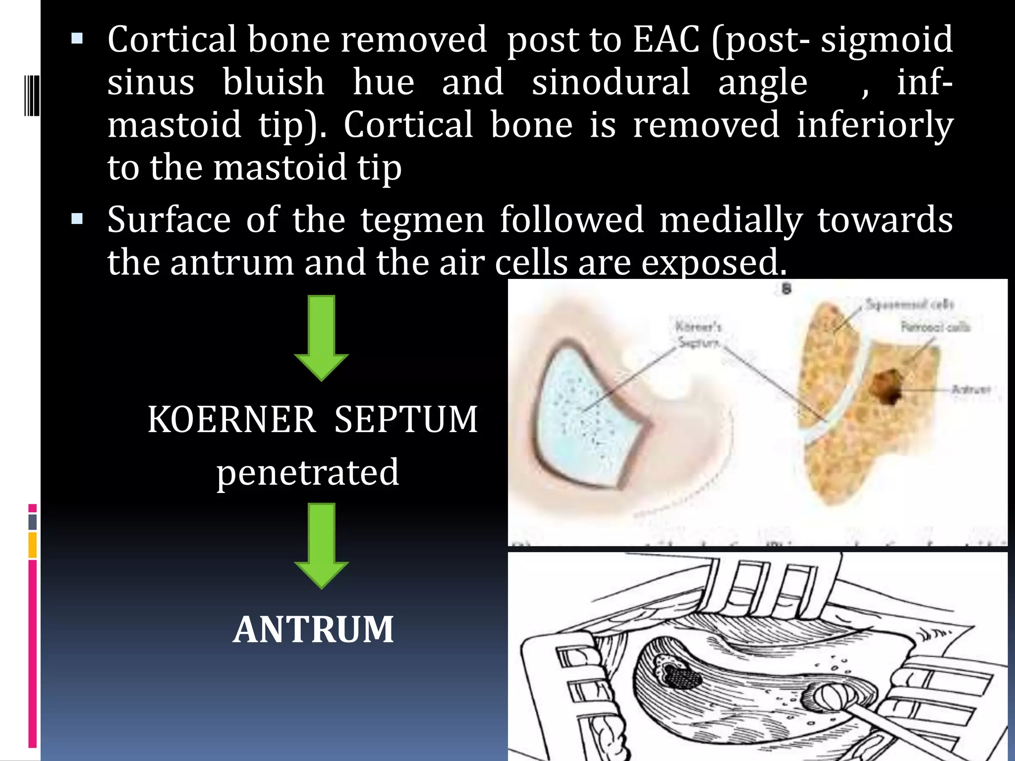 Canal wall up Mastoidectomy ( Intact Bridge Mastoidectomy) by Dr.Aditya ...