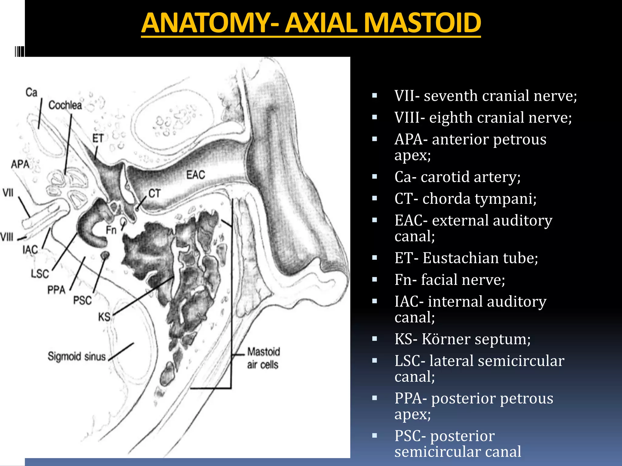 Canal wall up Mastoidectomy ( Intact Bridge Mastoidectomy) by Dr.Aditya ...