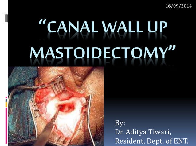 Canal wall up Mastoidectomy ( Intact Bridge Mastoidectomy) by Dr.Aditya ...