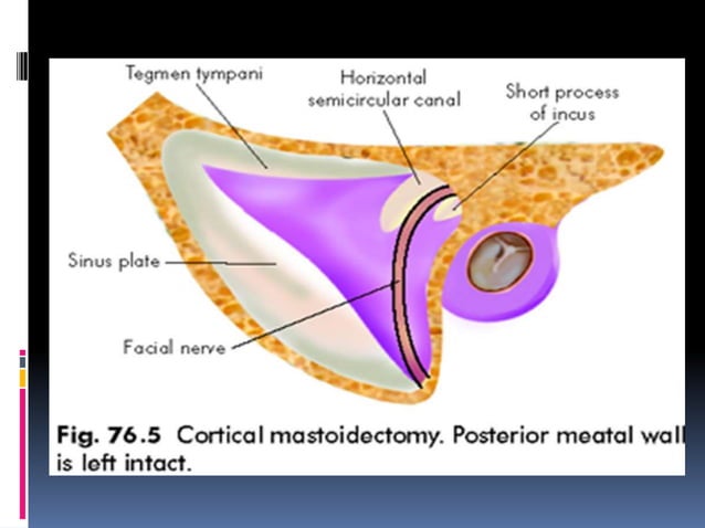 Canal wall up Mastoidectomy ( Intact Bridge Mastoidectomy) by Dr.Aditya ...