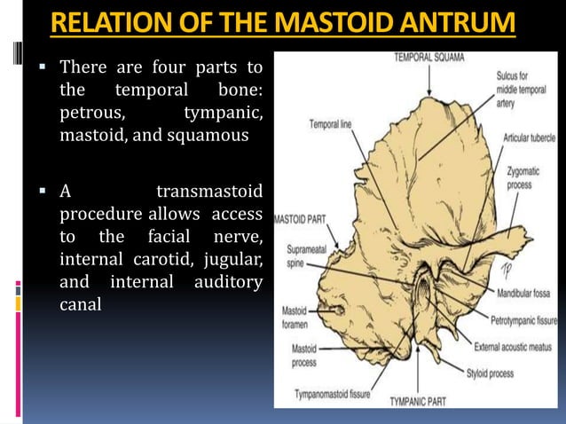 Canal wall up Mastoidectomy ( Intact Bridge Mastoidectomy) by Dr.Aditya ...