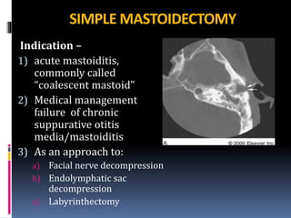 Canal Wall Down Mastoidectomy Radiology