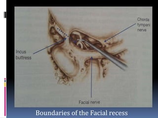 Facial Recess Approach