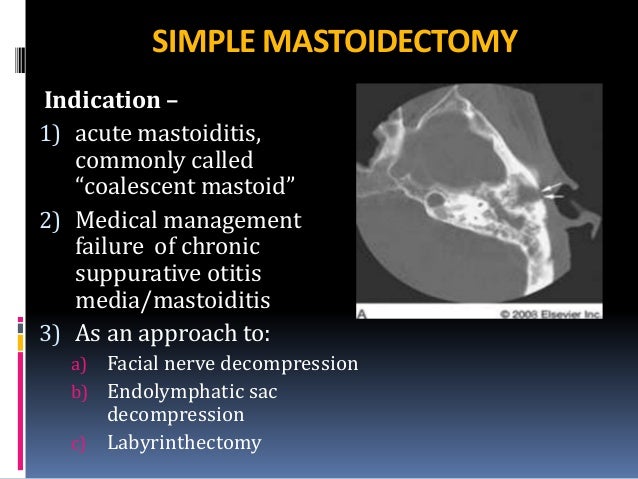 Mastoidectomy Draping