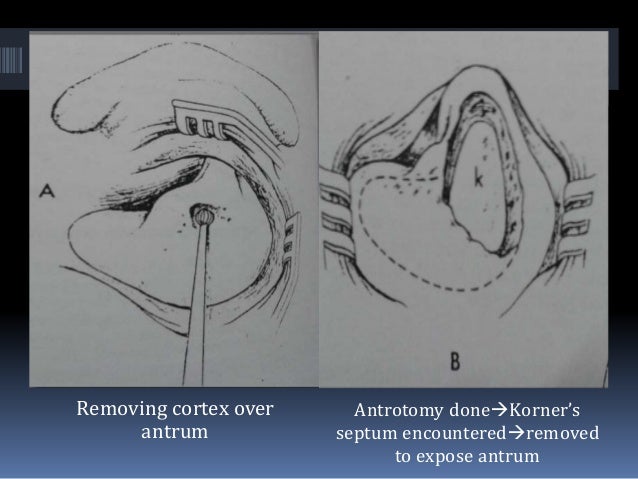 Mastoidectomy Draping