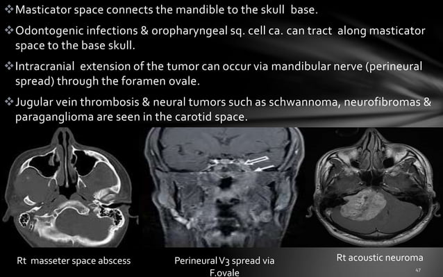Skull base anatomy by Dr. Aditya Tiwari | PPTX | Death, Injury, or ...