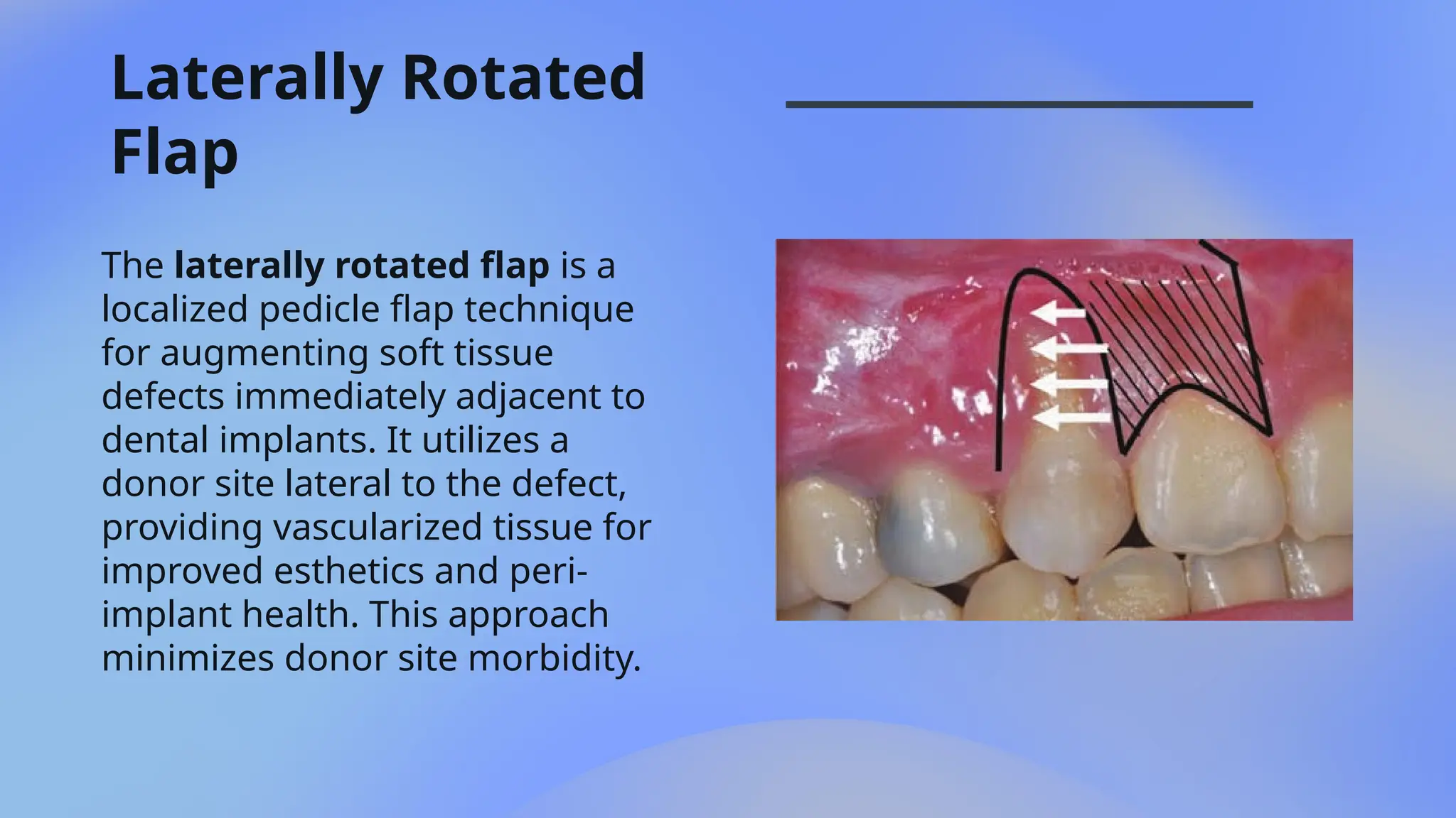 Adjacent Implants soft & hard tissue Augmentation.pptx