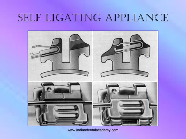 Adjuncts in straight wire technique /certified fixed orthodontic courses by Indian dental ...