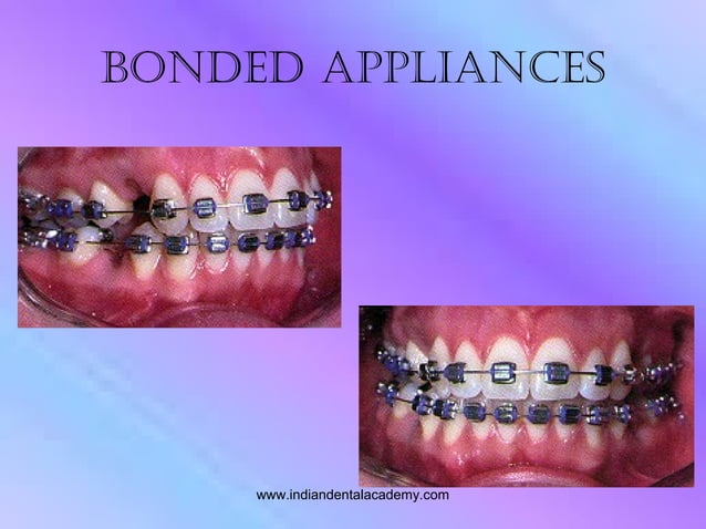 Adjuncts in straight wire technique /certified fixed orthodontic courses by Indian dental ...