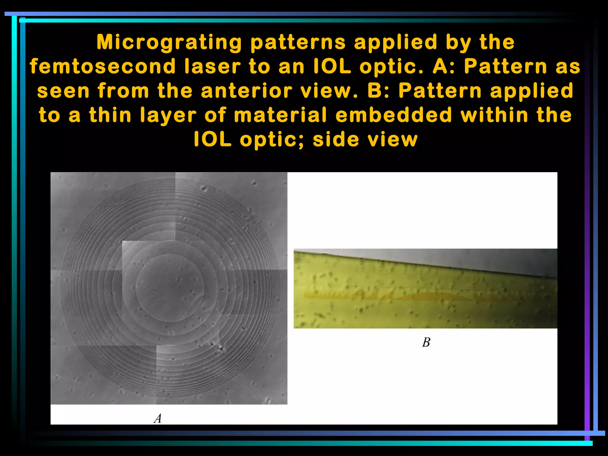 Adjustable intraocular lens power | PPT