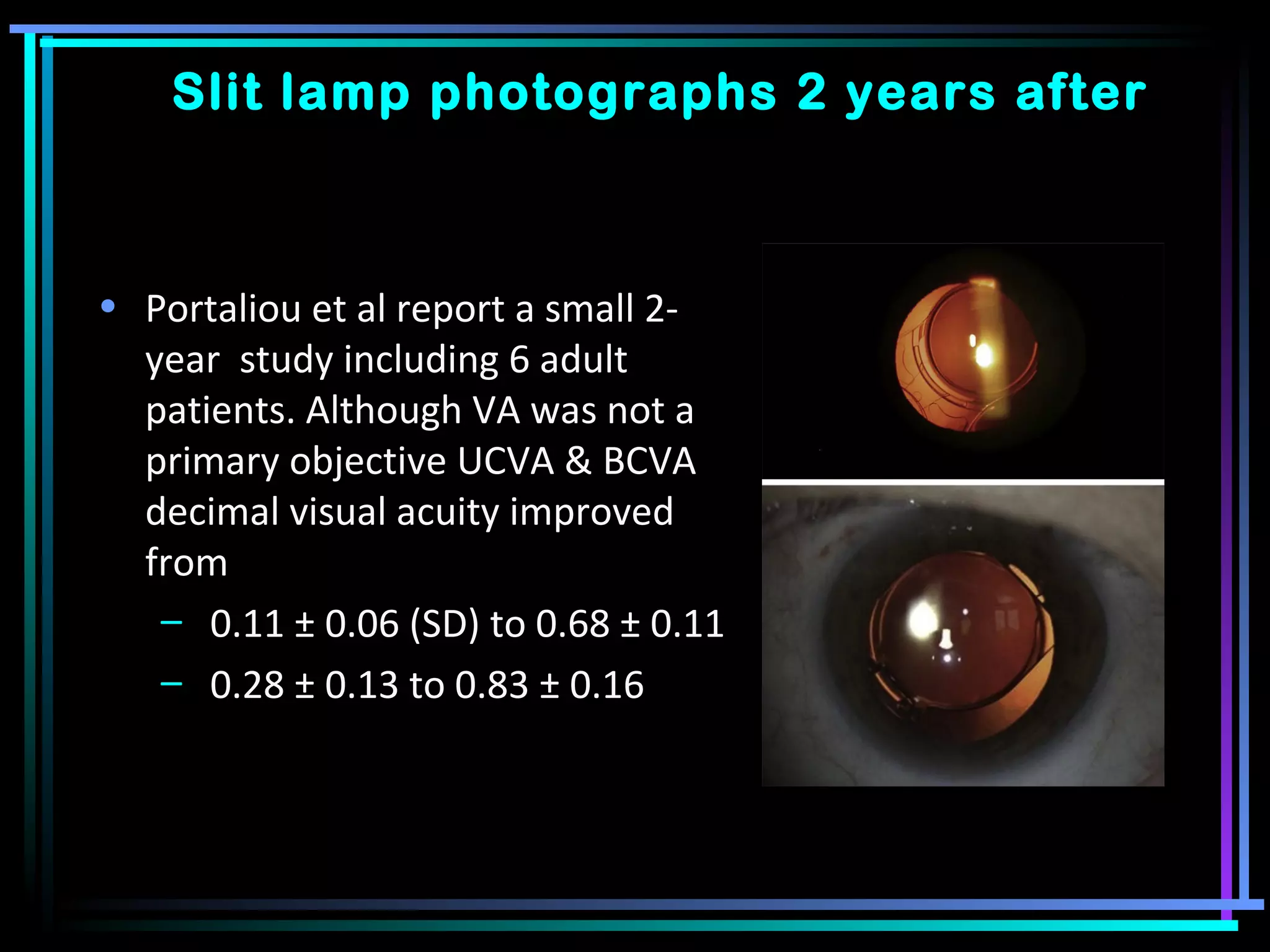 Adjustable intraocular lens power | PPT