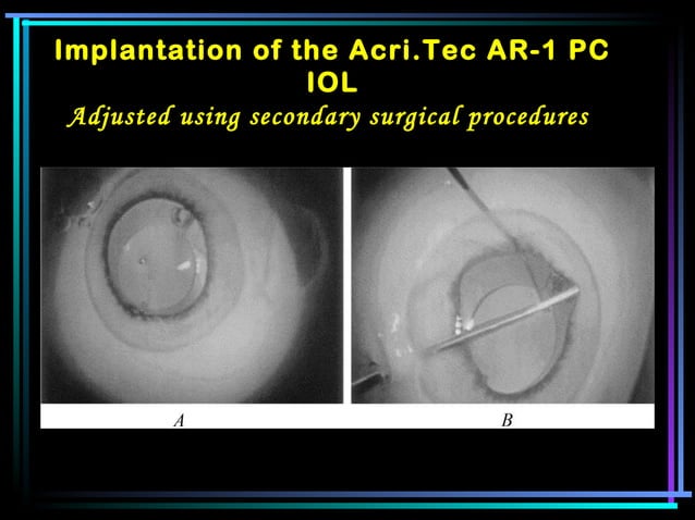 Adjustable intraocular lens power | PPT