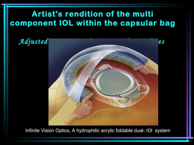 Adjustable intraocular lens power | PPT