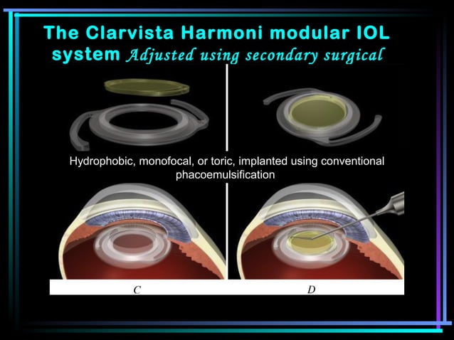 Adjustable intraocular lens power | PPT