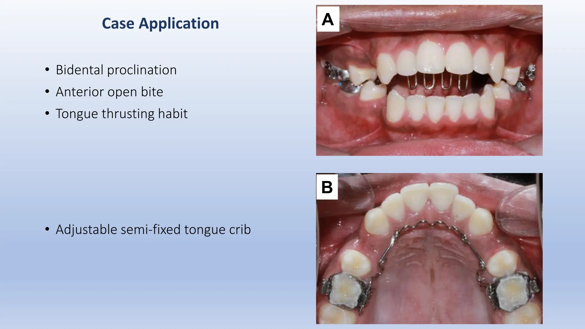 ADJUSTABLE TONGUE CRIB.pptx