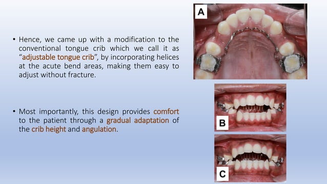 ADJUSTABLE TONGUE CRIB.pptx | Dental Health | Diseases and Conditions