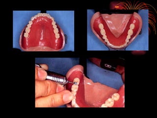 Adjustment Of Complete Denture Occlusion Ppt
