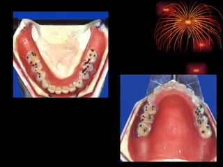 Adjustment Of Complete Denture Occlusion Ppt