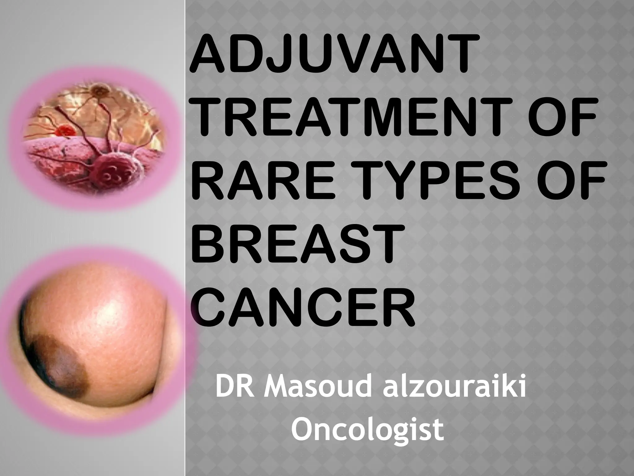 Adjuvant treatment of rare types of breast cancer.pptx