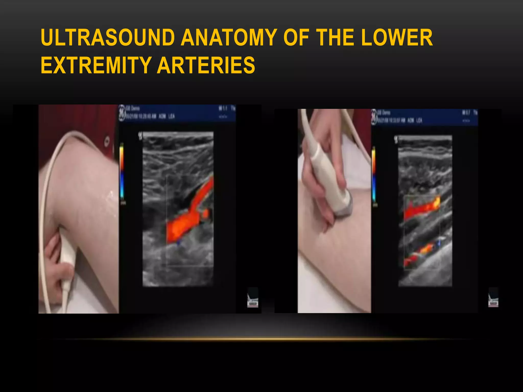 Arterial doppler lower limbs.pptx
