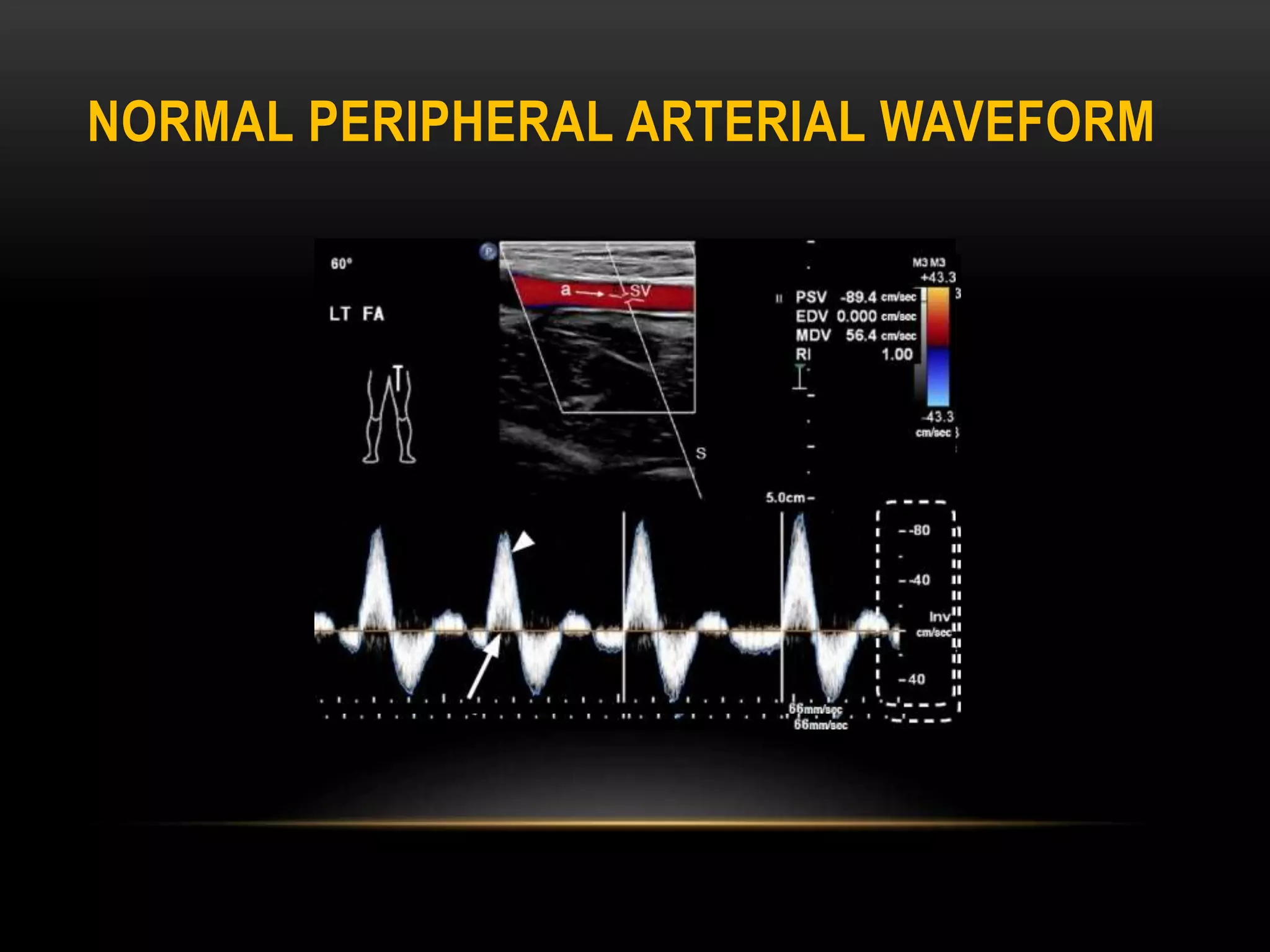 Arterial doppler lower limbs.pptx