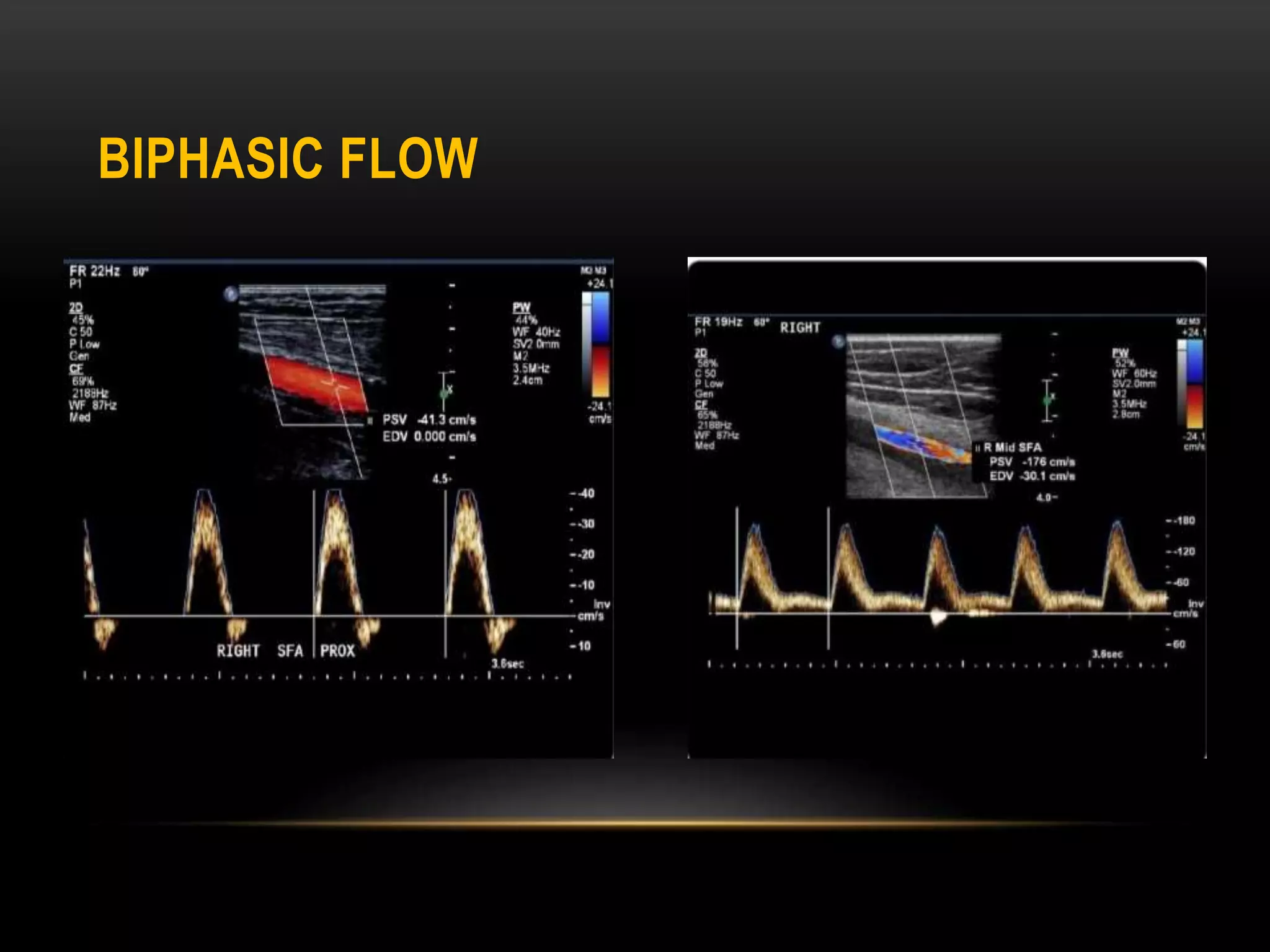 Arterial doppler lower limbs.pptx