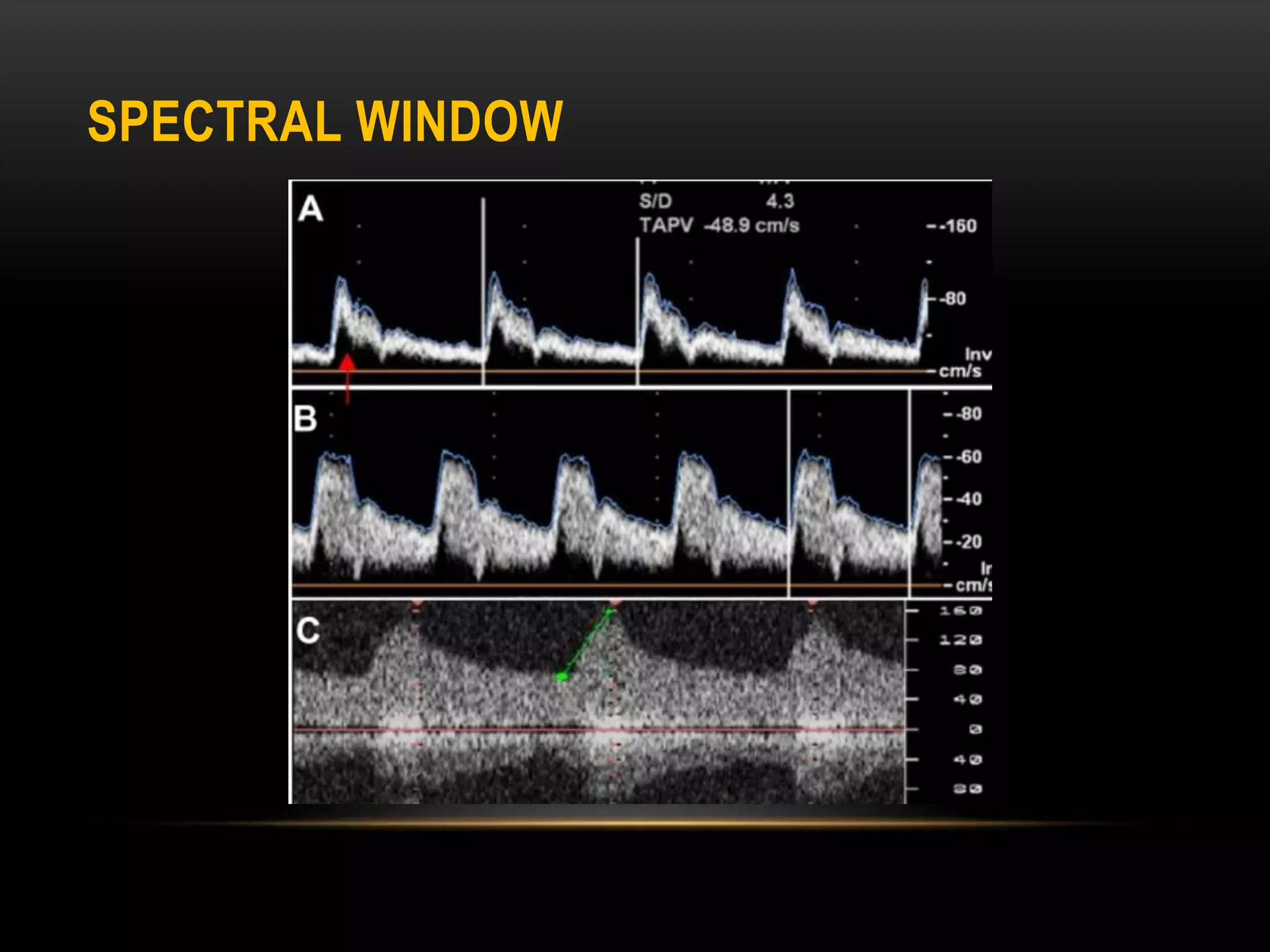 Arterial doppler lower limbs.pptx