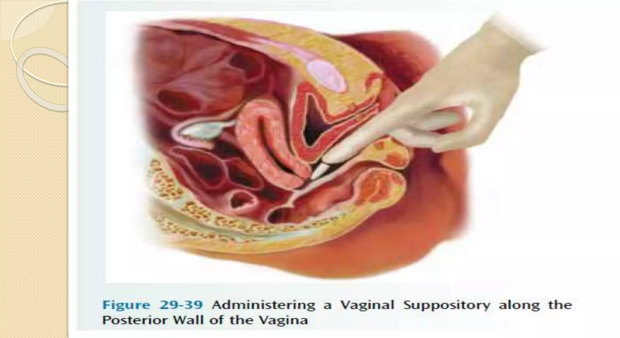 Administering vaginal suppository.pptx