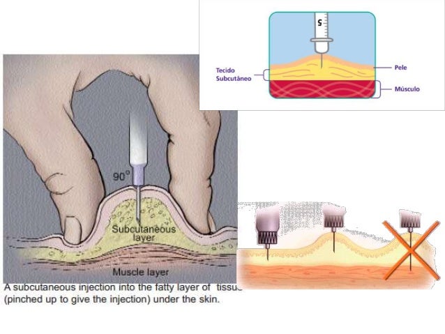 Administração medicamentos via subcutanea