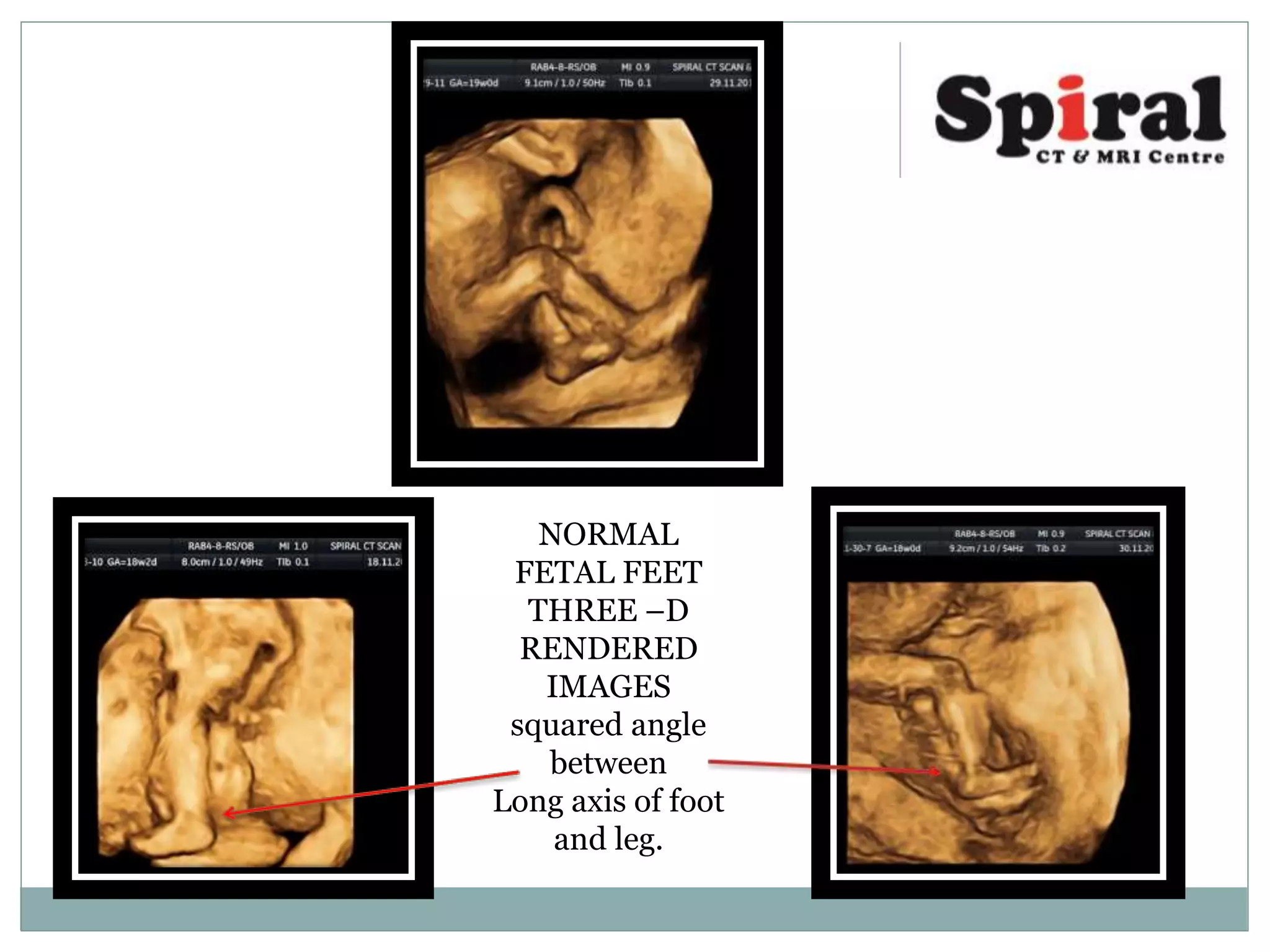 ADVANCED USG LOUNGE FETAL FEET | PPT